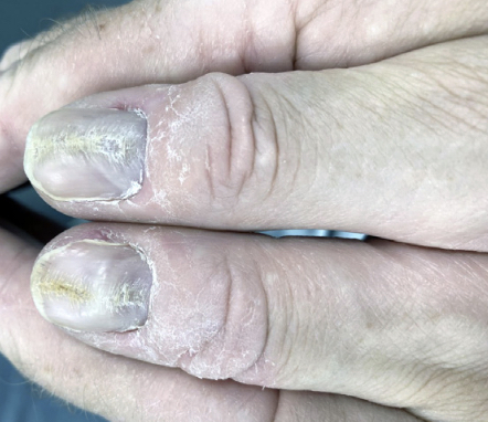 Oral health impacts of nutritional deficiencies – Timothy Ives